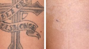 Waarom een tattoo verwijderen? | Het Lasercentrum